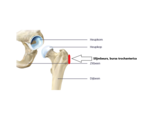 Bij Bergman kunt u terecht voor een behandeling slijmbeursontsteking