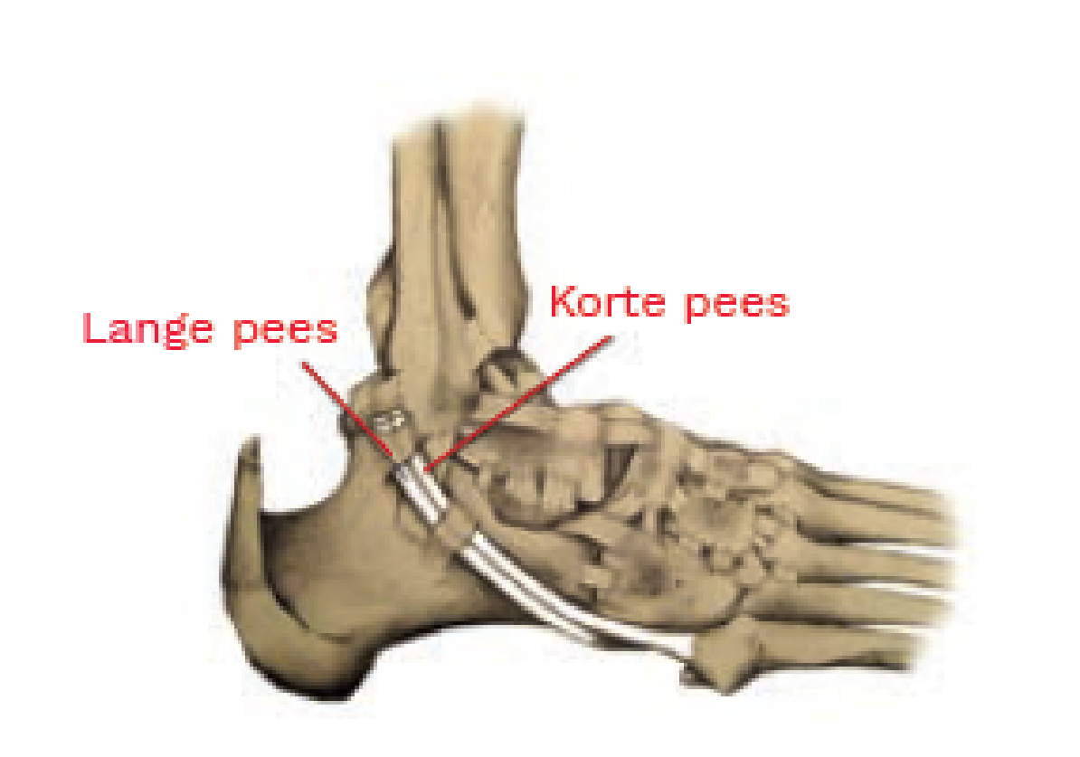 Bergman Clinics biedt een behandeling van peroneuspees-probleem aan.