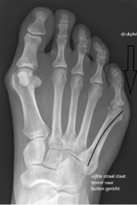 Bergman Clinics biedt behandeling van bult met scheefstand kleine teen.