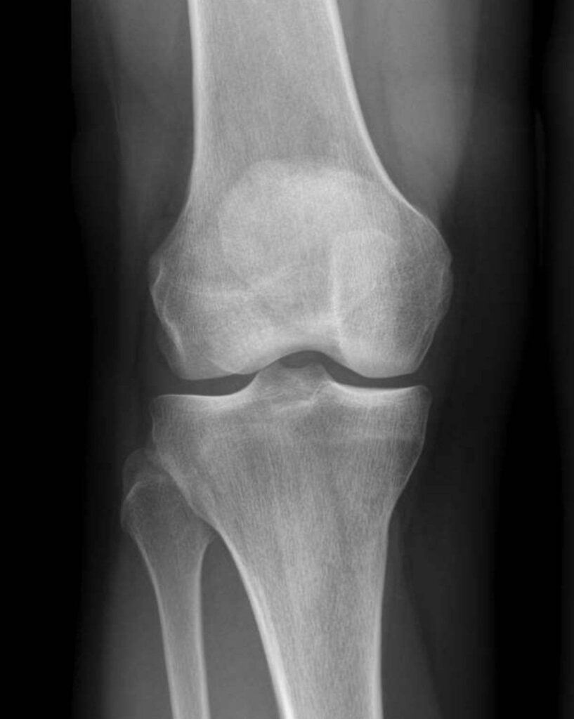 Bij Bergman Clinics Breda kunt u terecht voor een behandeling van artrose