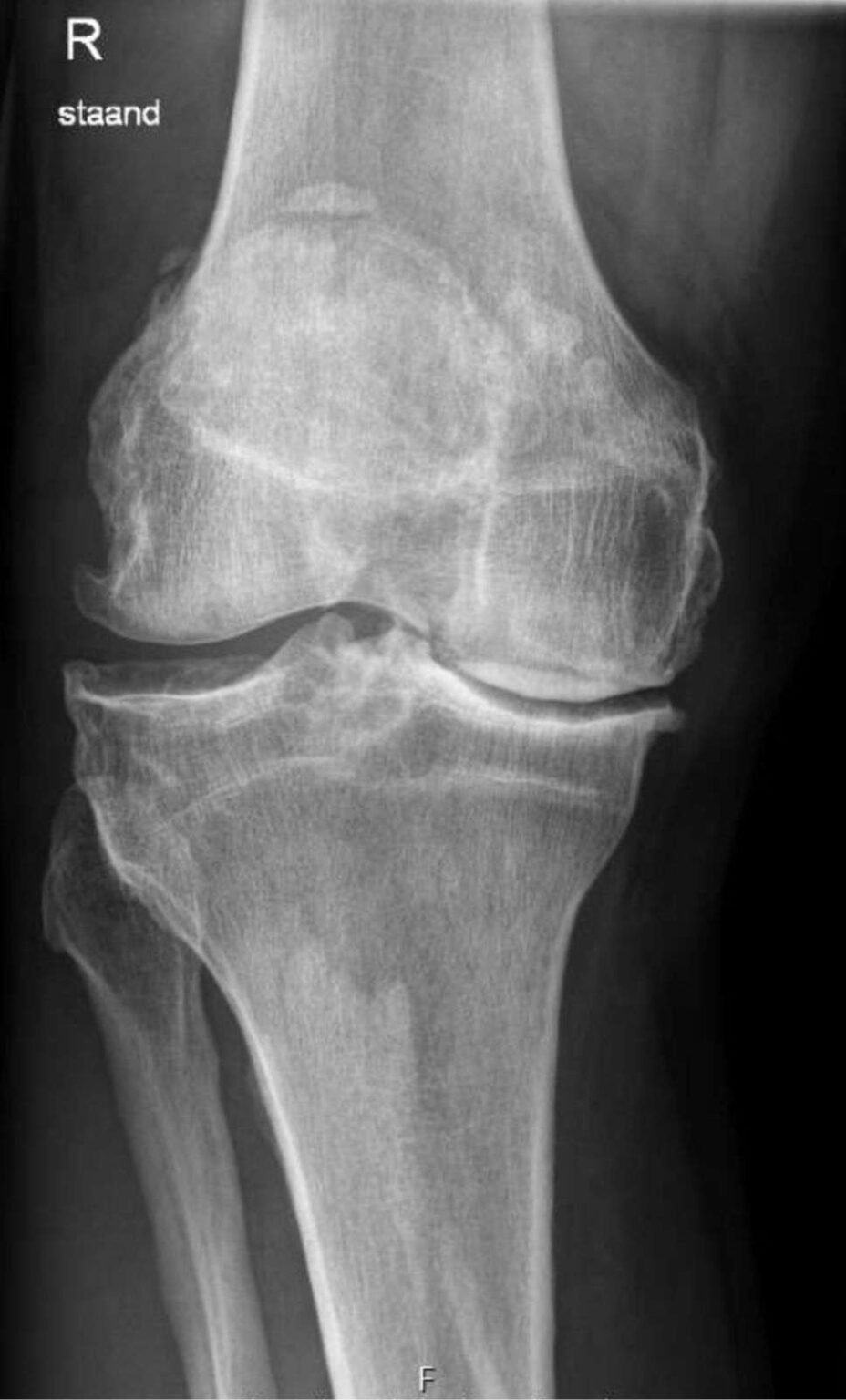 Bij Bergman Clinics Breda Kunt U Terecht Voor Een Behandeling Van Artrose